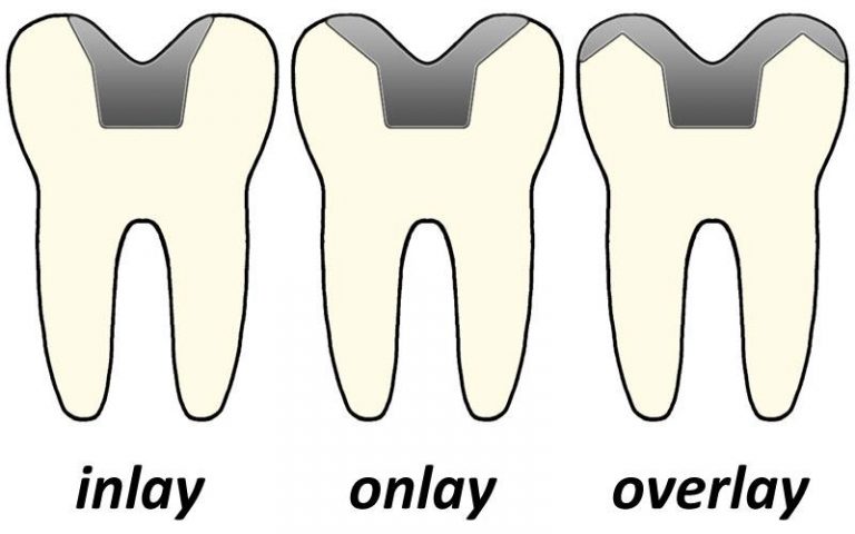 Indirect Restoration | Klinik Gigi Joy Dental