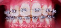 Pasang Behel Gigi di Klinik Gigi Joy Dental