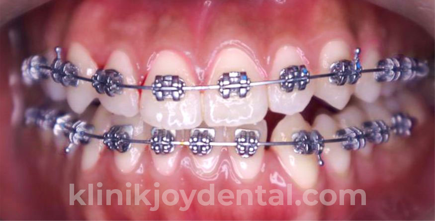 Pasang Behel Gigi di Klinik Gigi Joy Dental