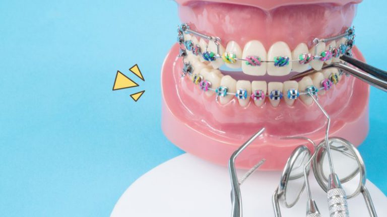 Bracket Behel Sering Lepas, Apakah Wajar? | Joy Dental