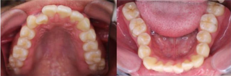 Pasang Behel Gigi Rahang Atas Saja, Bolehkah? | Joy Dental