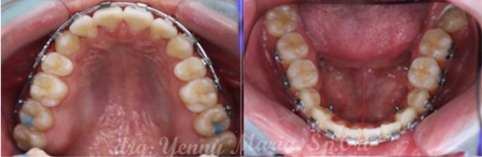 Pasang Behel Gigi Rahang Atas Saja, Bolehkah? | Joy Dental