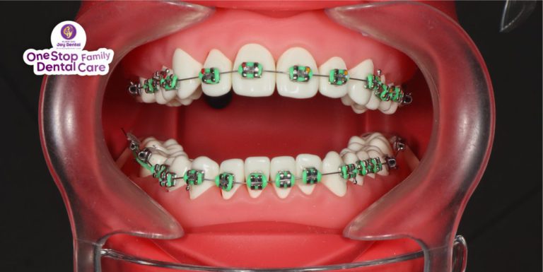 Behel Metal Manakah yang Cocok Untuk Anda?