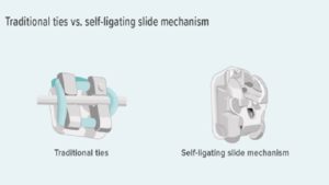 Behel Self Ligating: Inovasi Terkini dalam Perawatan Gigi | Joy Dental