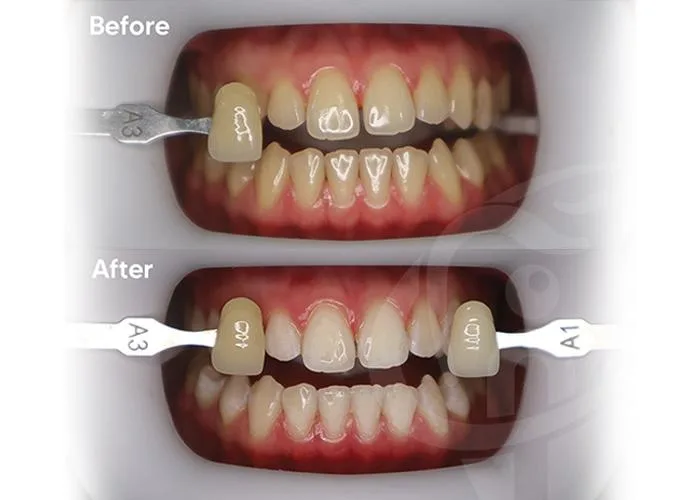 5 Tips Memutihkan Gigi Kuning Dengan Cepat Dan Aman